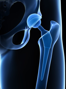 Metal-on-Metal Hip Implants Cause Serious Injuries